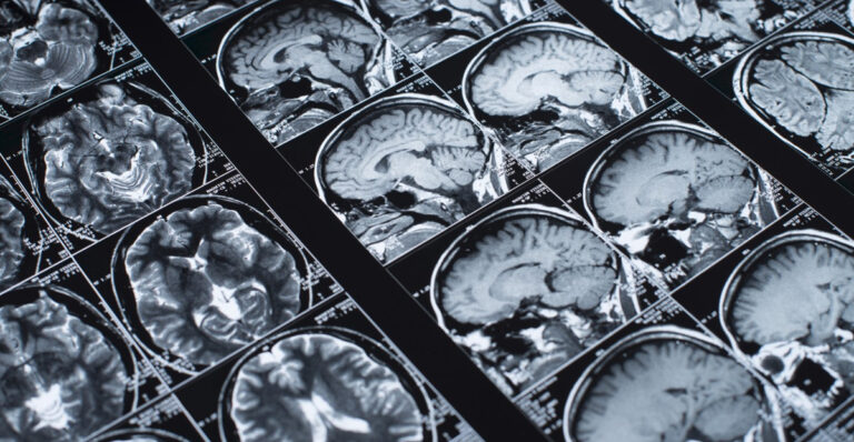 Skull Base Surgery for Tumor Removal